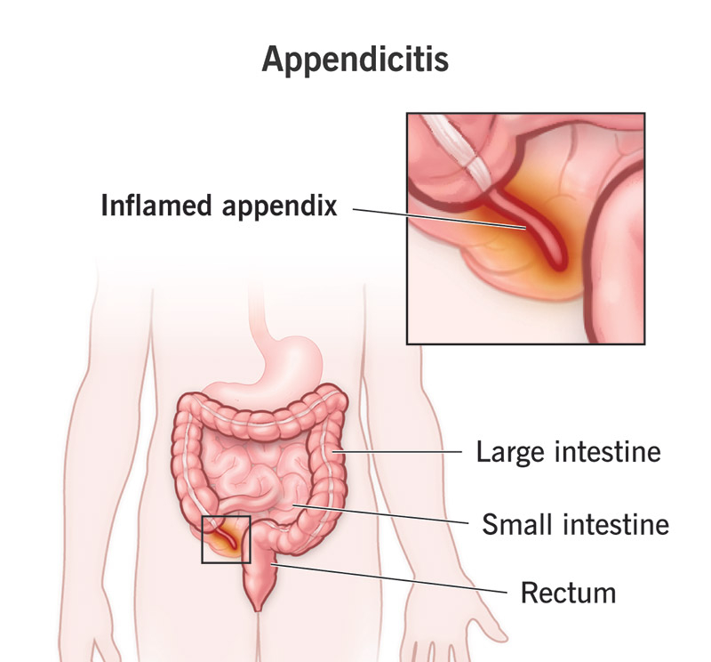 Important things you should about Appendix, Appendicitis and Appendectomy – Dr.Sudatta's Foot Fix